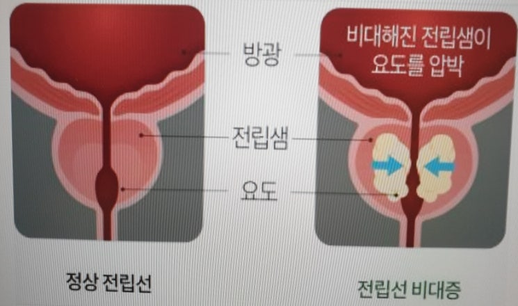 전립선 비대증 해결 원해 카리토포텐 효능 효과 부작용 복용 방법 완벽 정리 네이버 블로그