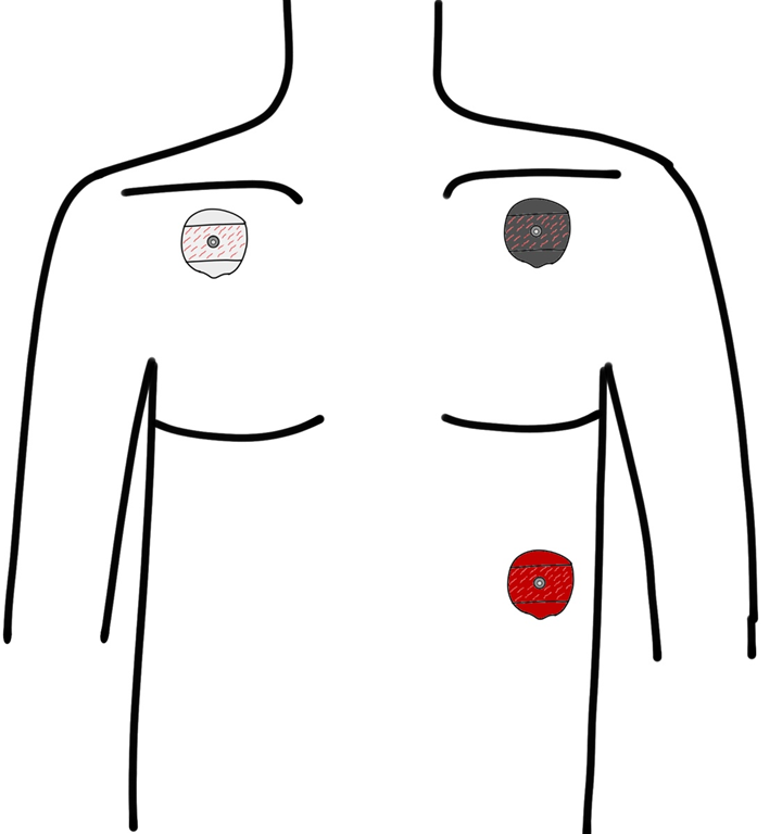 EKG 부착 부위 EKG ECG patch 부착 방법 심전도 모니터 : 네이버 블로그