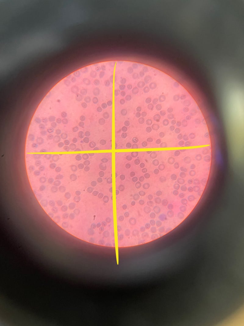 Reticulocyte망상적혈구의 정의 및 count 방법 : 네이버 블로그