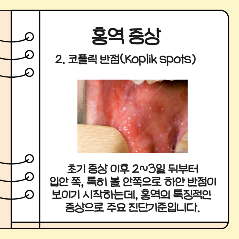 홍역(Measles)의 모든 것 - 홍역증상, 홍역예방접종(MMR), 홍역치료법, 홍역사망률, 홍역전염, 코플릭 반점 ...
