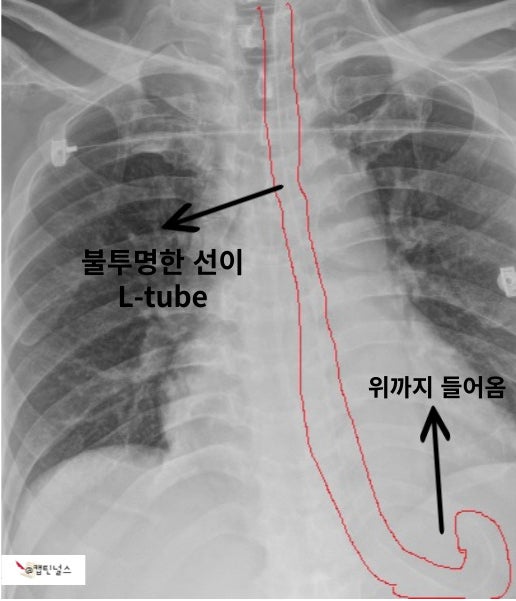 L-tube 삽입 물품 과정 및 올바른 위치 확인과 주의사항 : 네이버 블로그