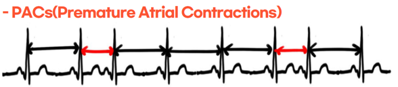 EKG해석 APC VPC A-fib VT VF asystole PEA 알아보기 : 네이버 블로그