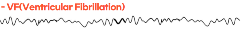 EKG해석 APC VPC A-fib VT VF asystole PEA 알아보기 : 네이버 블로그