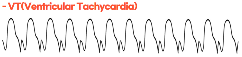 EKG해석 APC VPC A-fib VT VF asystole PEA 알아보기 : 네이버 블로그