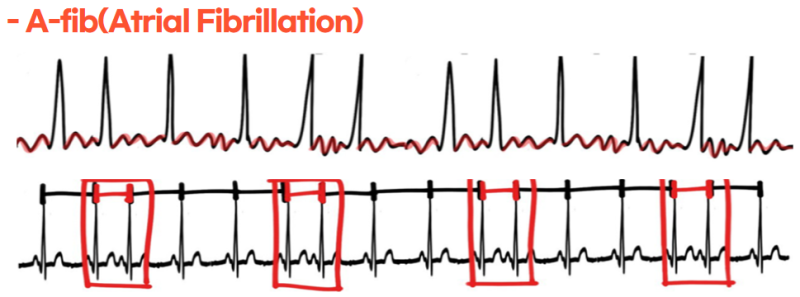 EKG해석 APC VPC A-fib VT VF asystole PEA 알아보기 : 네이버 블로그