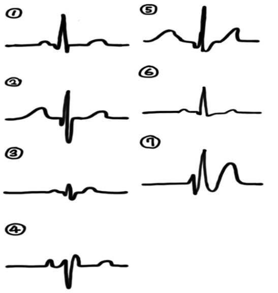 EKG해석 APC VPC A-fib VT VF asystole PEA 알아보기 : 네이버 블로그