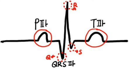EKG해석 APC VPC A-fib VT VF asystole PEA 알아보기 : 네이버 블로그