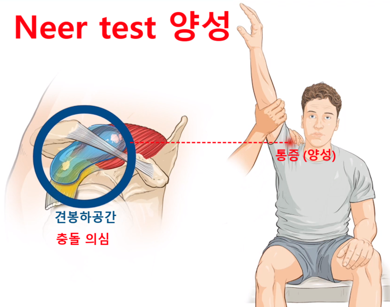 어깨충돌증후군 증상 및 원인 그리고 스페셜 테스트(Neer Test, Hawkins Kennedy Test) : 네이버 블로그