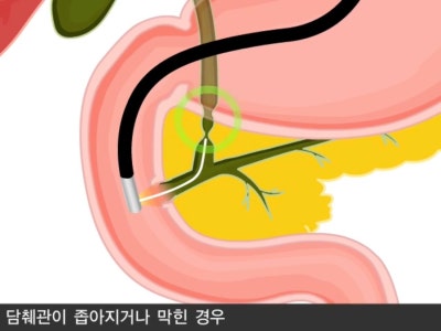 의학용어 ERCP(내시경적역행담췌관조영술) 주의사항 및 간호, ENBD,ERBD, ENPD, ERPD : 네이버 블로그