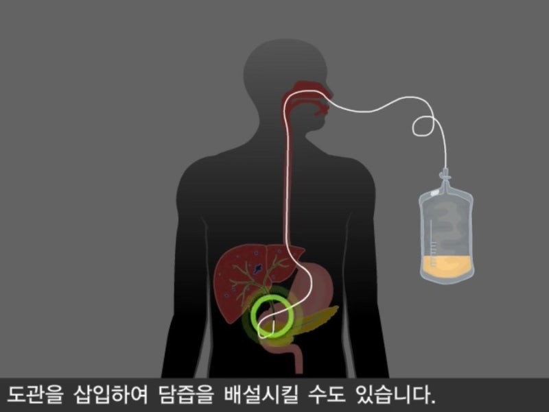 의학용어 ERCP(내시경적역행담췌관조영술) 주의사항 및 간호, ENBD,ERBD, ENPD, ERPD : 네이버 블로그