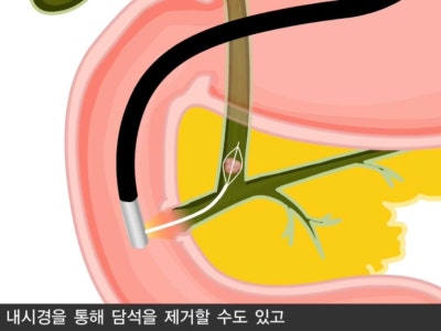 의학용어 ERCP(내시경적역행담췌관조영술) 주의사항 및 간호, ENBD,ERBD, ENPD, ERPD : 네이버 블로그