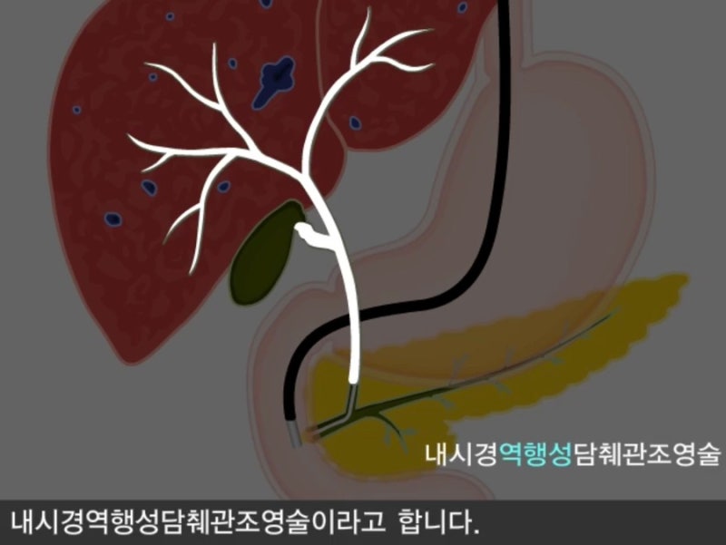 의학용어 ERCP(내시경적역행담췌관조영술) 주의사항 및 간호, ENBD,ERBD, ENPD, ERPD : 네이버 블로그