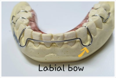 Wraparound retainer / Hawley retainer / adam's -circum retainer 유지장치 ...