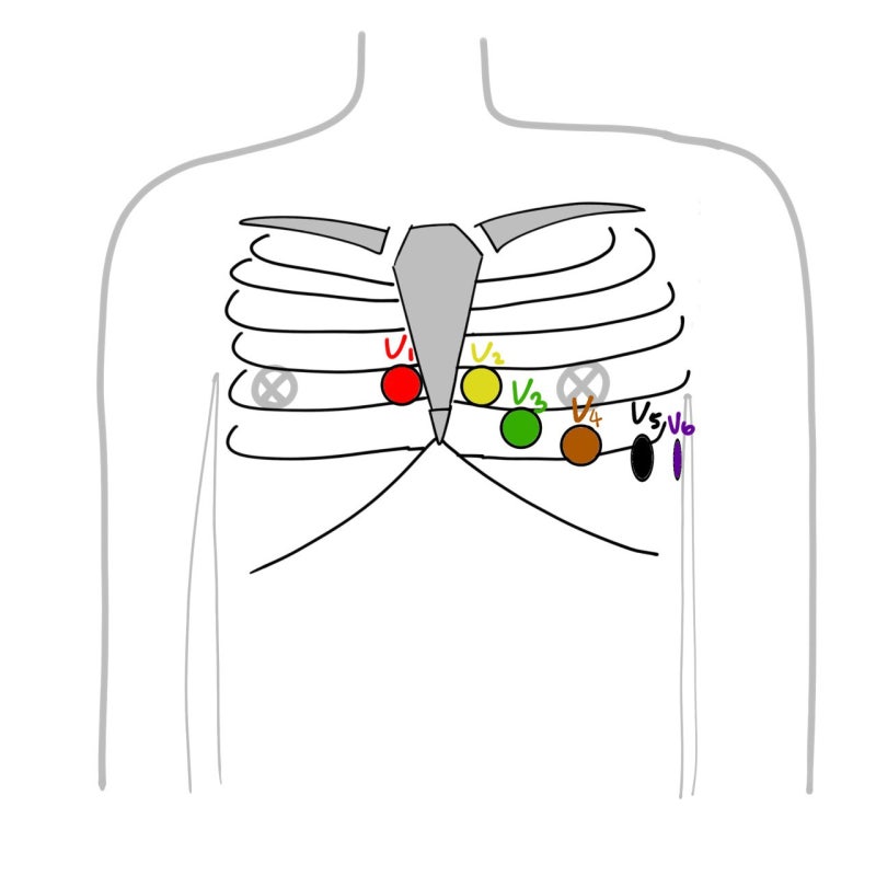 12 lead ekg 부착 방법, 검사 준비, 주의사항 : 네이버 블로그