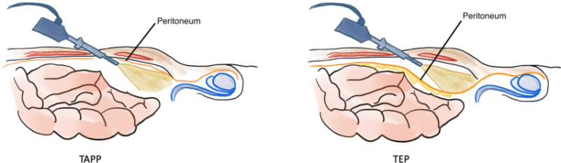 [OR] TEP & TAPP - 탈장수술 : 네이버 블로그