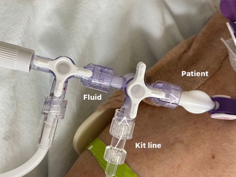 중심정맥관 및 정맥압(Central venous line& pressure,C-line&CVP) : 네이버 블로그