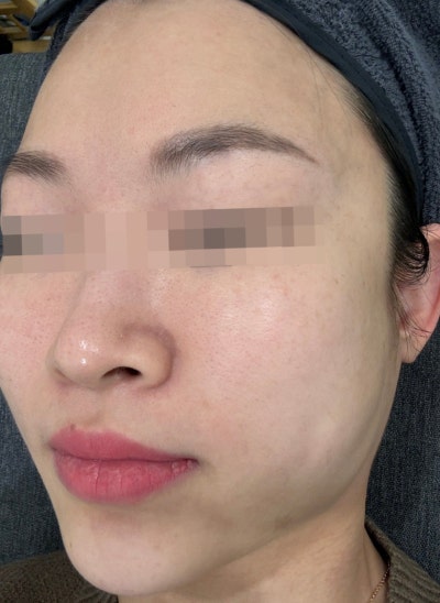 피코웨이토닝 3회차 전후 변화 피코토닝 효과 내돈내산 솔직후기 네이버 블로그
