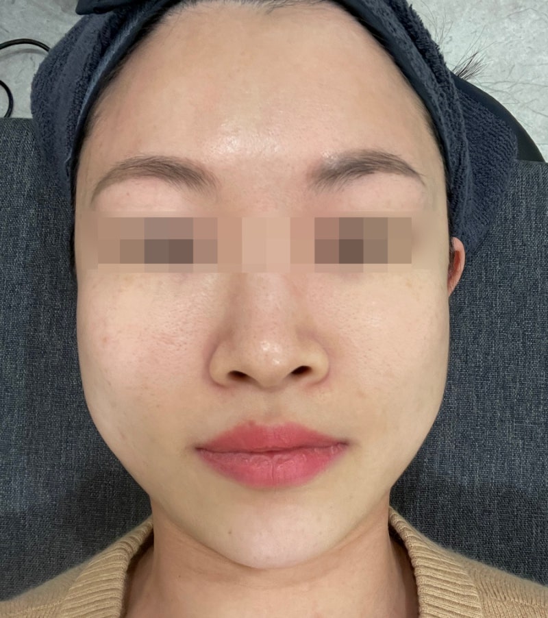피코웨이토닝 3회차 전후 변화 피코토닝 효과 내돈내산 솔직후기 네이버 블로그