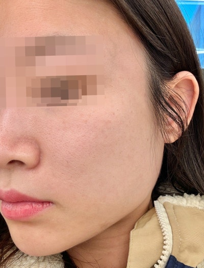 피코웨이토닝 3회차 전후 변화 피코토닝 효과 내돈내산 솔직후기 네이버 블로그