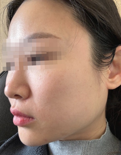 피코웨이토닝 3회차 전후 변화 피코토닝 효과 내돈내산 솔직후기 네이버 블로그