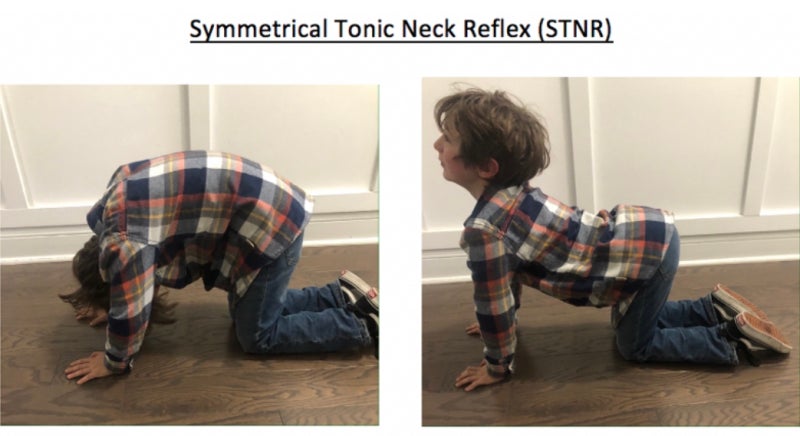 [감각통합기능 임상관찰]임상관찰 반사평가 방법 : STNR,ATNR,Righting reaction,쉴더상지신전검사,평형반응 ...
