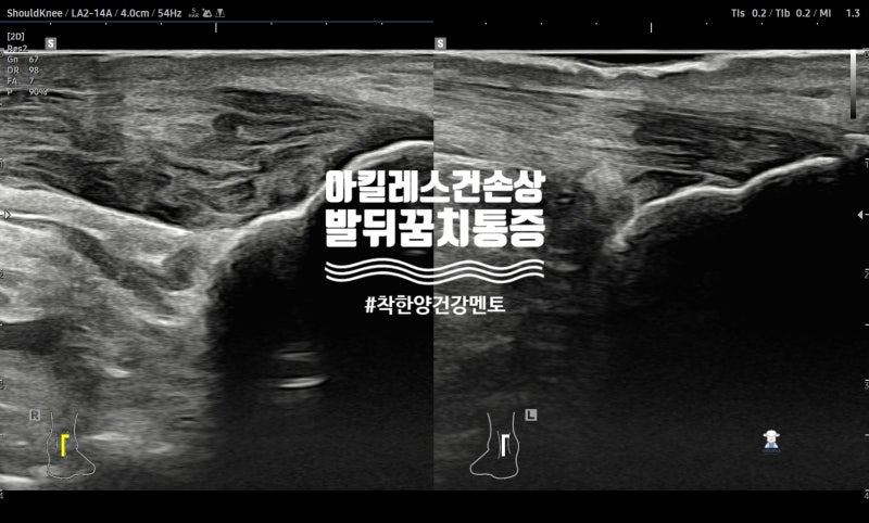 발목 뒤 통증 아킬레스 건염 통증 치료 및 스트레칭 운동방법 네이버 블로그