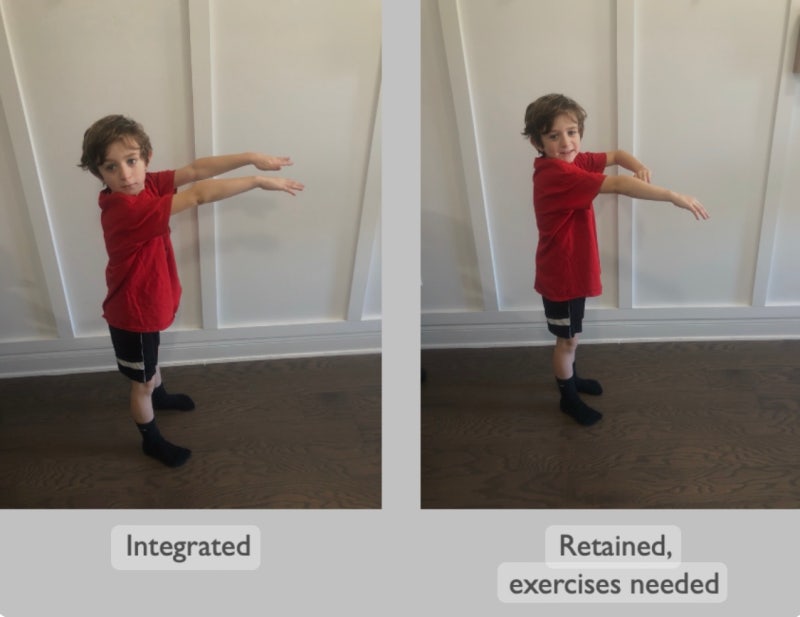 [감각통합기능 임상관찰]임상관찰 반사평가 방법 : STNR,ATNR,Righting reaction,쉴더상지신전검사,평형반응 ...