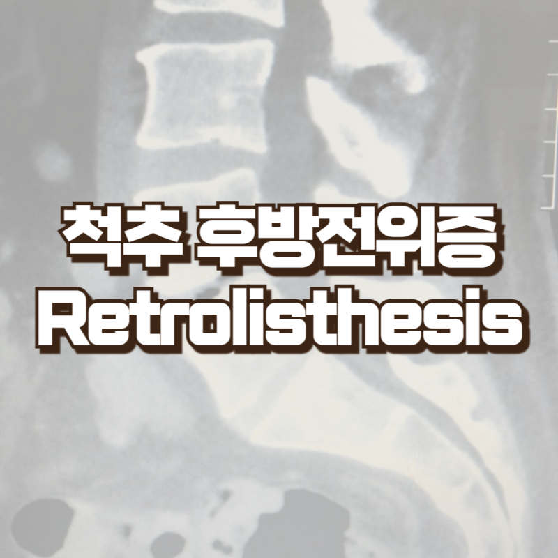 척추후방전위증 (Retrolisthesis) 간단 정리 : 네이버 블로그