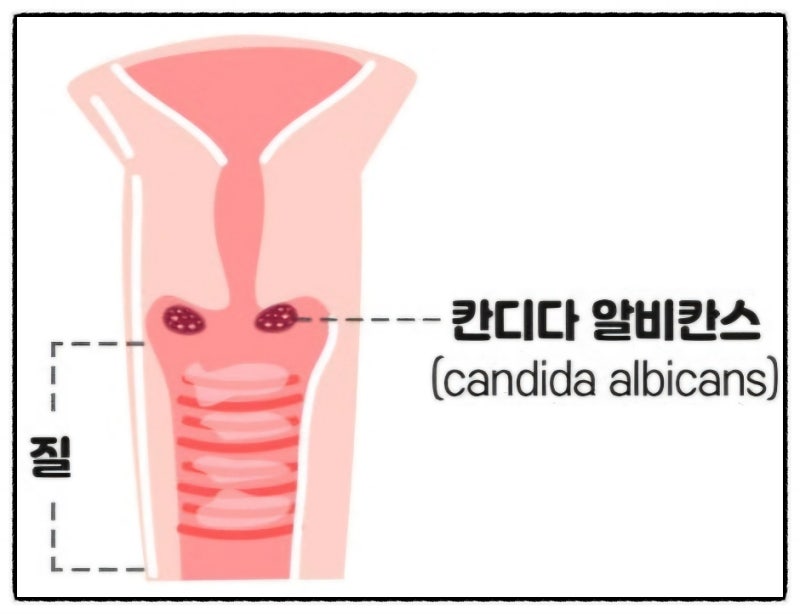 질염 치료제 지노프로질정 가격 성분 사용방법 효과 및 부작용 네이버 블로그