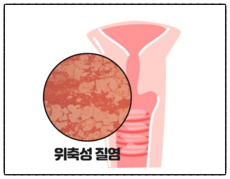 질염 치료제 지노프로질정 가격 성분 사용방법 효과 및 부작용 네이버 블로그