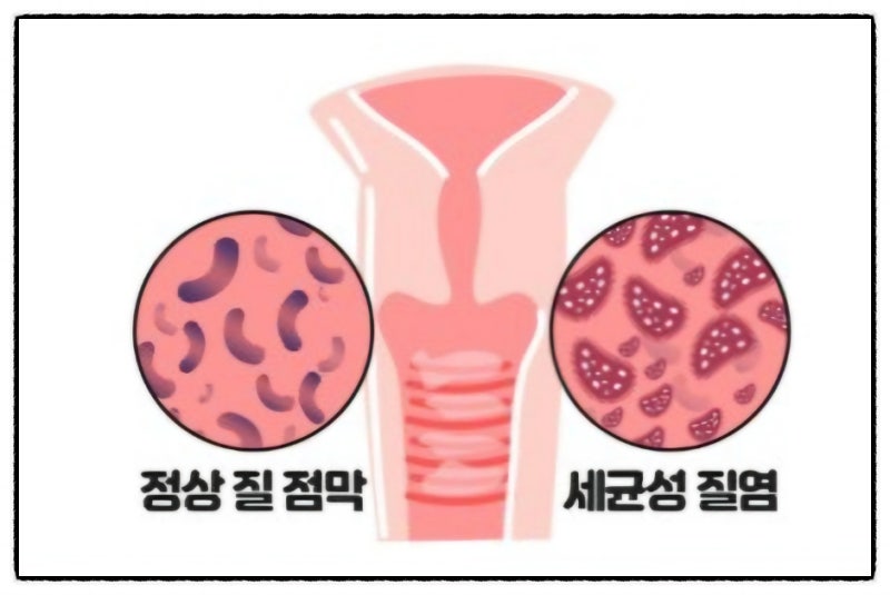 질염 치료제 지노프로질정 가격 성분 사용방법 효과 및 부작용 네이버 블로그