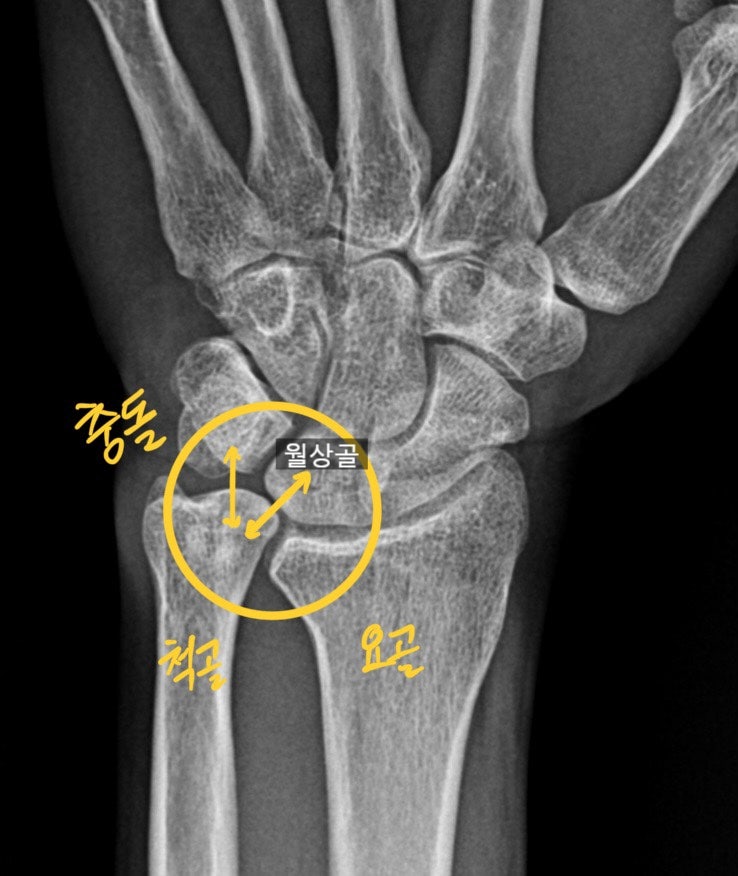 척골 충돌 증후군 손목의 척골ulnar이 길어서 생기는 통증 척골 단축술의 효과 Ulnar Shortening