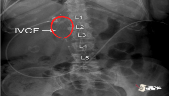 하대정맥 필터 삽입술(IVC filter insertion) 시행하는 이유 및 IVC filter insertion 후 주의사항 ...