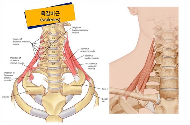 목갈비근(사각근), scalenes(TOS 근육) 해부학적 위치와 작용, 촉진 및 검사 방법, 치료 고려사항, 기능해부학 ...