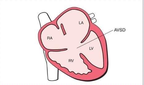 심방 중격 결손증(ASD), 심실 중격 결손증(VSD), 방실 중격 결손증(AVSD) 종류 특징 차이 초음파 임상경과 예후 치료 ...