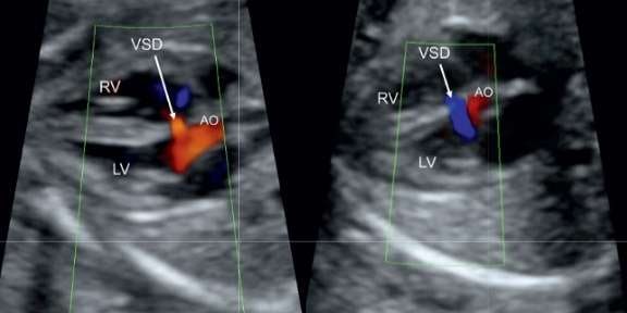 심방 중격 결손증(ASD), 심실 중격 결손증(VSD), 방실 중격 결손증(AVSD) 종류 특징 차이 초음파 임상경과 예후 치료 ...