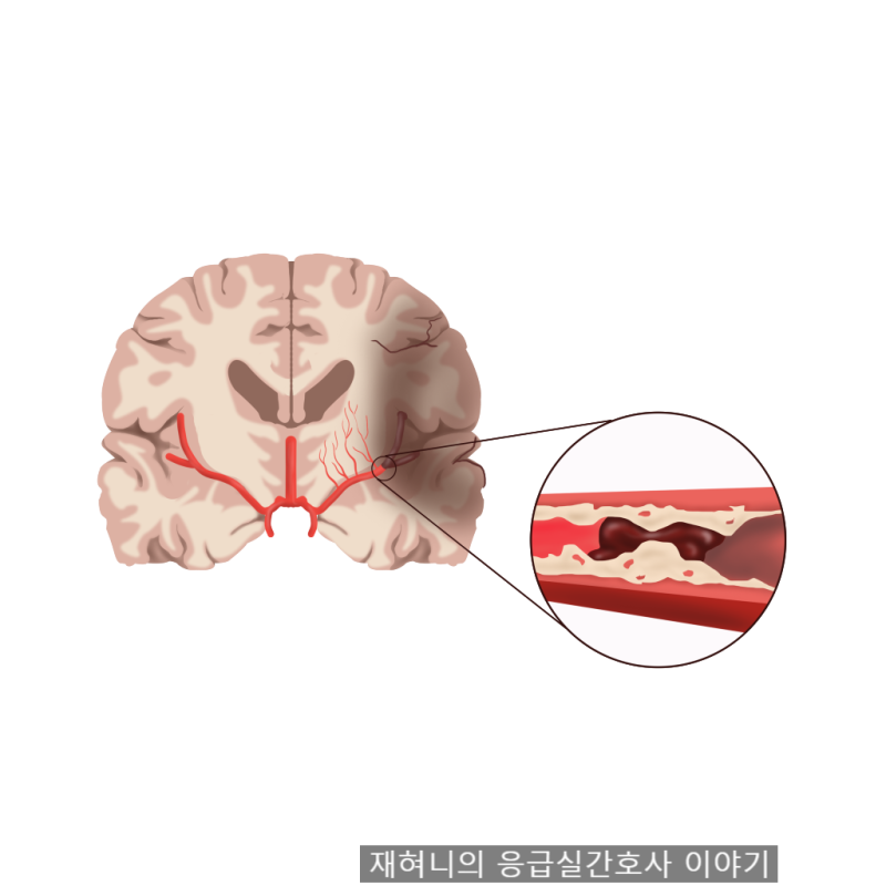 뇌졸중 전조증상과 의학용어 ICH SDH SAH의 CT 비교 : 네이버 블로그