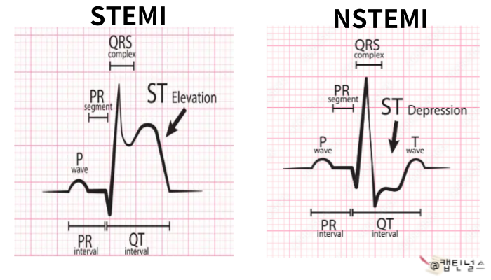 STEMI와 NSTEMI 특징 및 EKG 차이점과 원인 및 치료 : 네이버 블로그