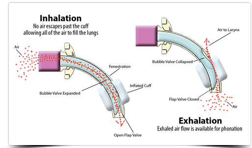 Tracheostomy 기관절개술 기관절개관 유형 간호 portex tracoe : 네이버 블로그