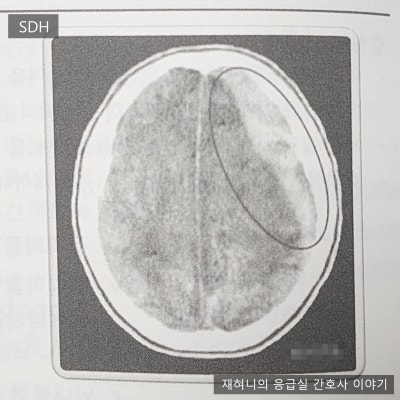 뇌출혈 환자의 약물 치료와 두개내압 정상범위 IICP : 네이버 블로그
