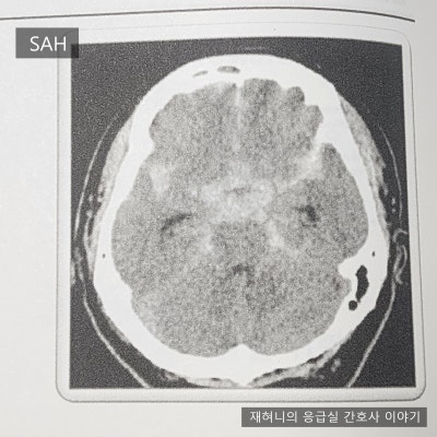 뇌출혈 환자의 약물 치료와 두개내압 정상범위 IICP : 네이버 블로그