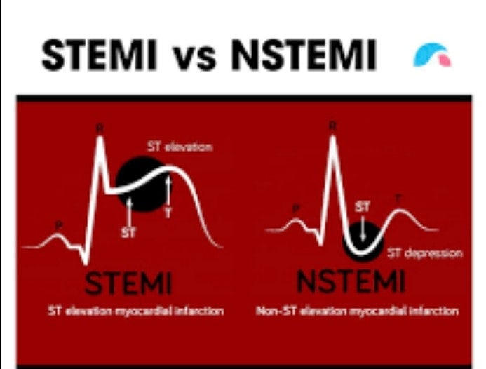 STEMI, NSTEMI 정의와 EKG 판독 및 치료에 대해 알아봐요~ : 네이버 블로그