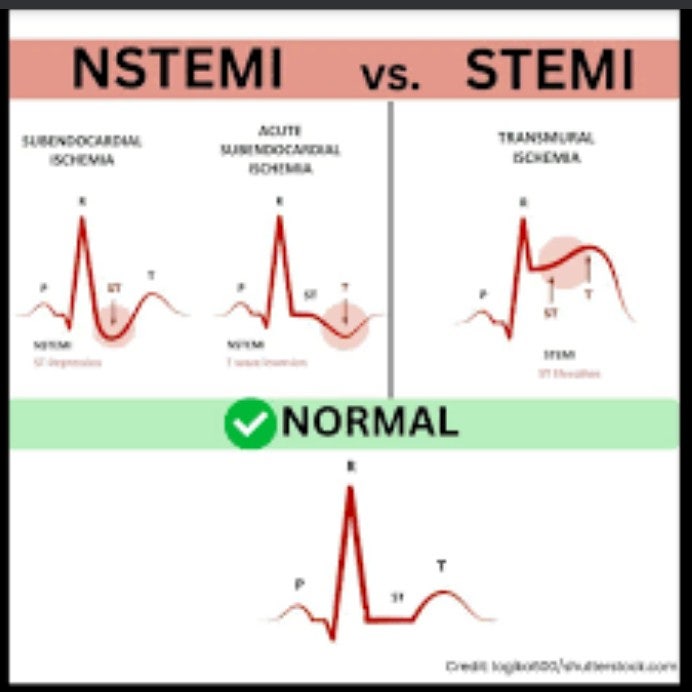 STEMI, NSTEMI 정의와 EKG 판독 및 치료에 대해 알아봐요~ : 네이버 블로그