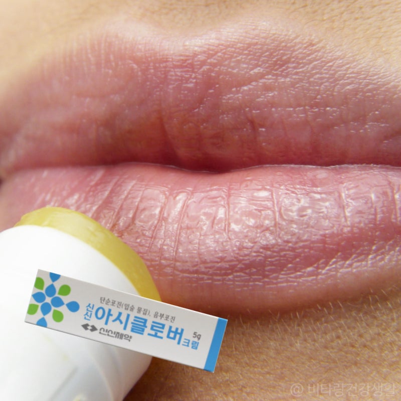 입술 헤르페스 감염 아시클로버 연고 효과는 어느정도 네이버 블로그