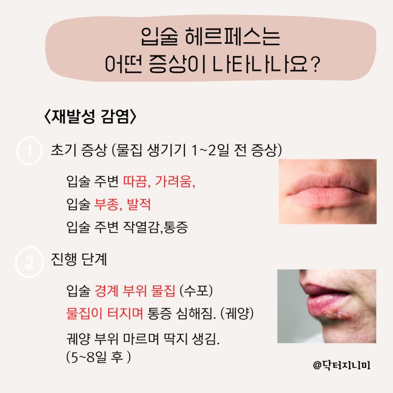 입술 헤르페스 수포 과연 전염이 되나요 증상과 치료 예방법까지 단순 헤르페스 바이러스 1 관련된 전반적인 내용까지