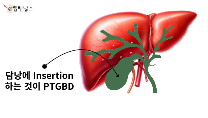 PTBD와 PTGBD 차이점 및 목적 그리고 시술 후 간호 : 네이버 블로그