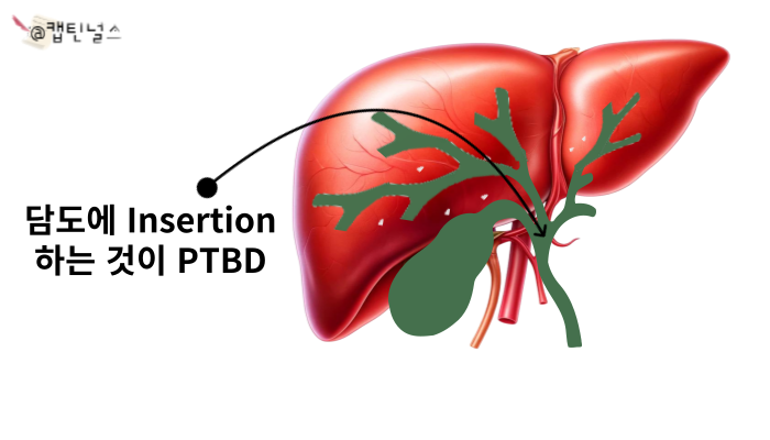PTBD와 PTGBD 차이점 및 목적 그리고 시술 후 간호 : 네이버 블로그