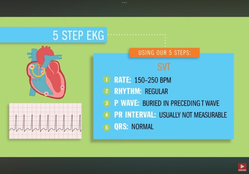 의학용어 PSVT, SVT 차이 공부하기, 전극도자절제술 (Atrial Ablation) : 네이버 블로그