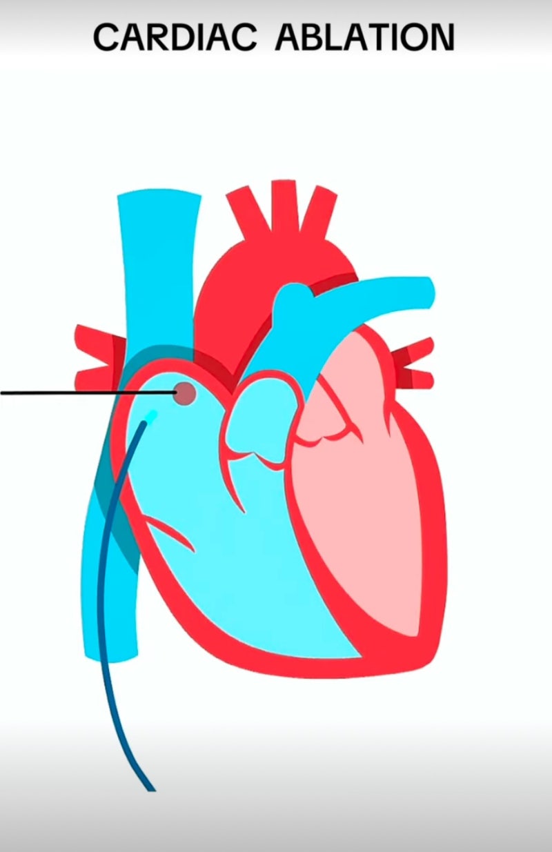 의학용어 PSVT, SVT 차이 공부하기, 전극도자절제술 (Atrial Ablation) : 네이버 블로그