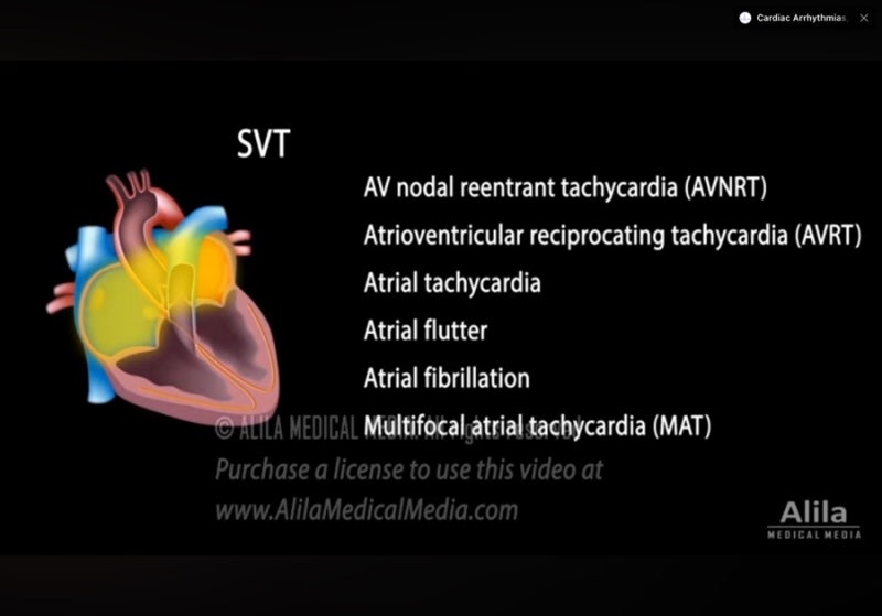 의학용어 PSVT, SVT 차이 공부하기, 전극도자절제술 (Atrial Ablation) : 네이버 블로그